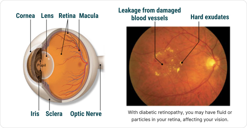 Diabetic Retinopathy - Ophthalmology Associates