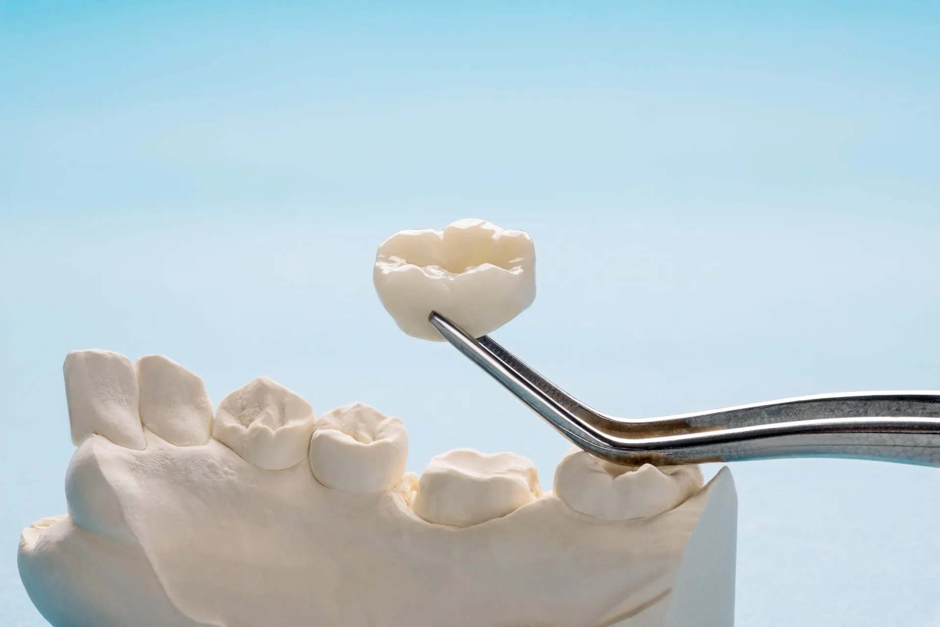 Ceramic Crowns – Enhancing Your Smile with Strength and Aesthetics