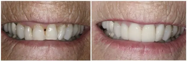 Enhance Your Smile with Porcelain Veneers | Coho Dental Anchorage, AK