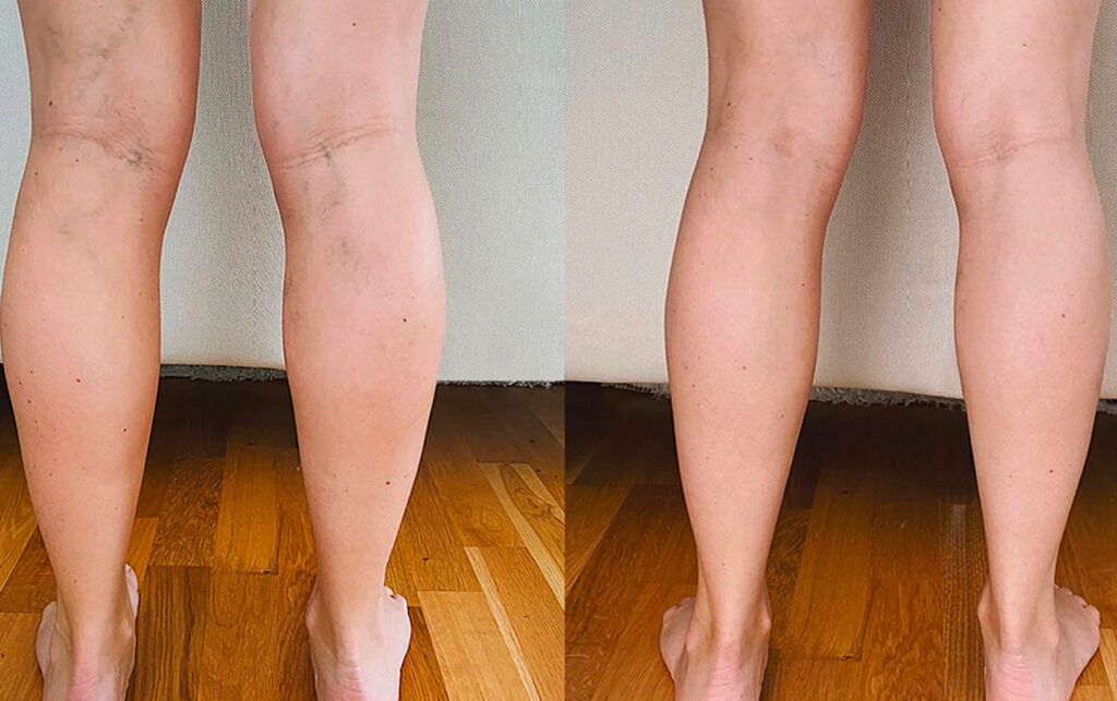 Varicose Veins - Cause, Symptoms and Treatment Pathway UK Vein Care