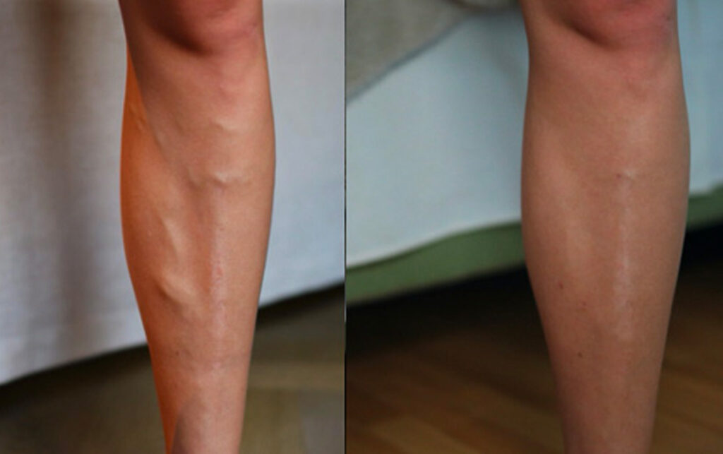 Leading Specialists in Varicose Vein Treatment UK Vein Care