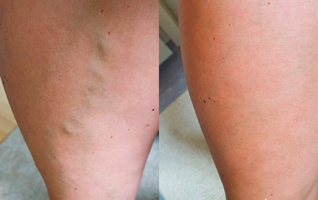 Varicose Veins - Cause, Symptoms and Treatment Pathway UK Vein Care