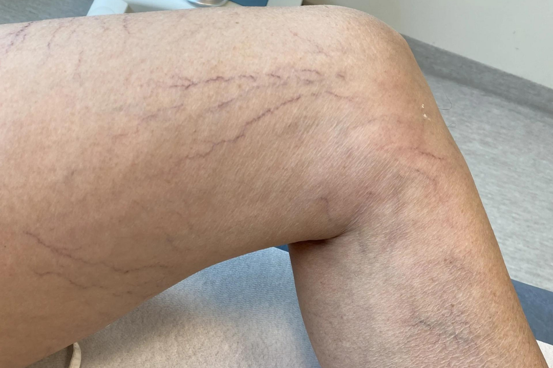 Ruptured blood vessels - UK Vein Care