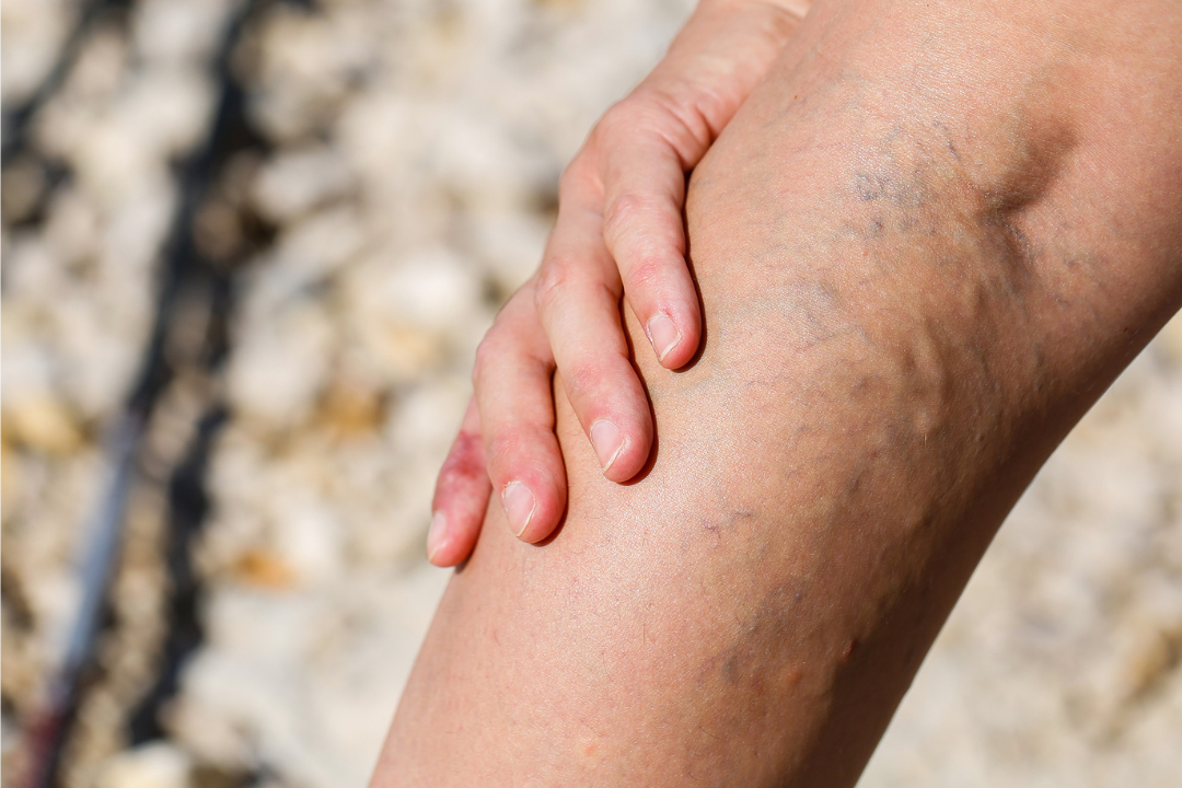 Side effects of varicose vein treatment - UK Vein Care