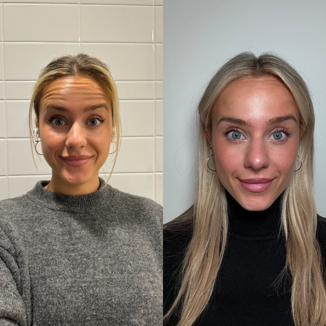 Avoid Counterfeit Botox: 10 Essential Tips | Pinch Med Spa