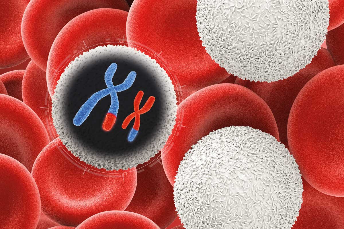 Acute Myeloid Leukemia (AML)