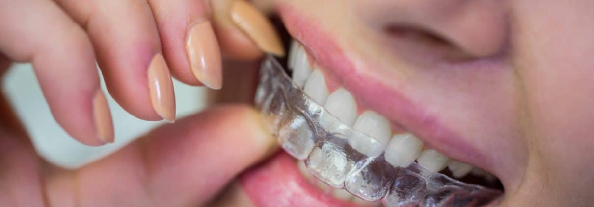 How Do Clear Aligners Work?