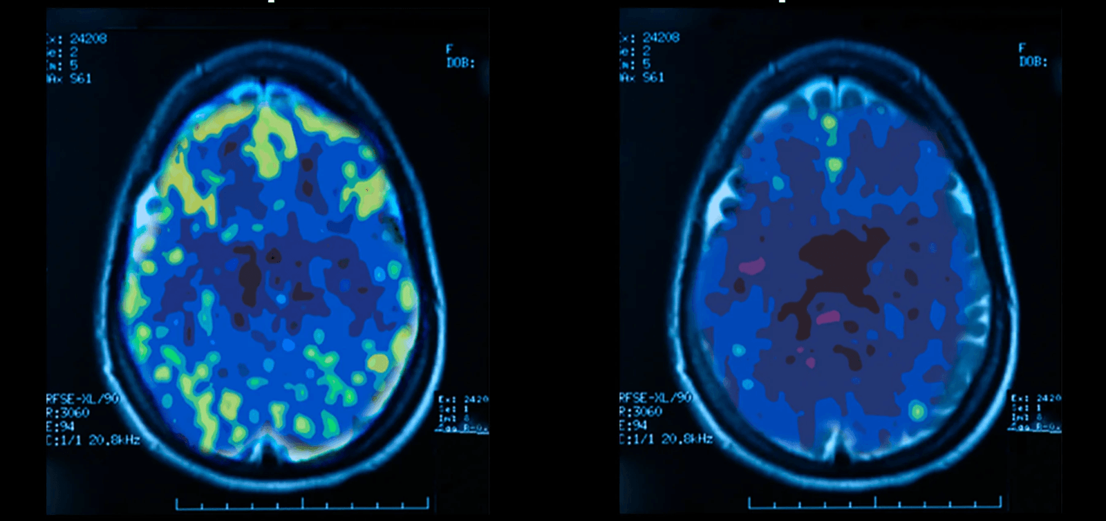 Samphire Neuroscience
